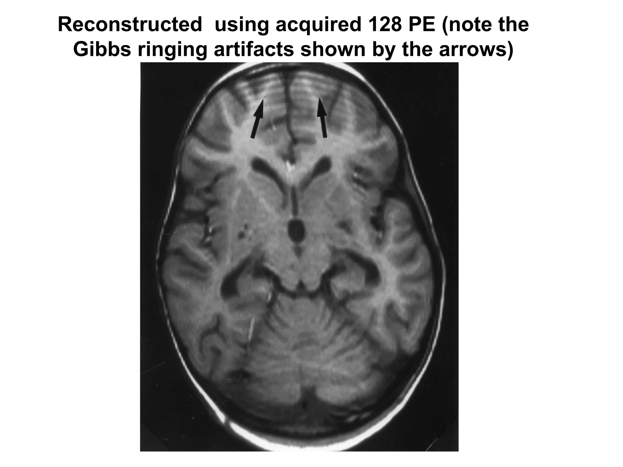 Mri Gibbs Ringing Artifact Reduction