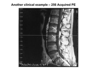 Mri Gibbs Ringing Artifact Reduction | PPT