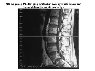 Mri Gibbs Ringing Artifact Reduction | PPT