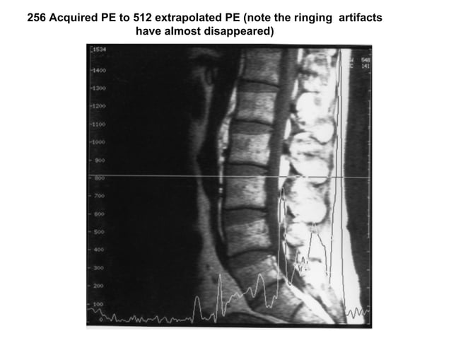 Mri Gibbs Ringing Artifact Reduction | PPT