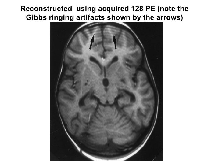 Mri Gibbs Ringing Artifact Reduction