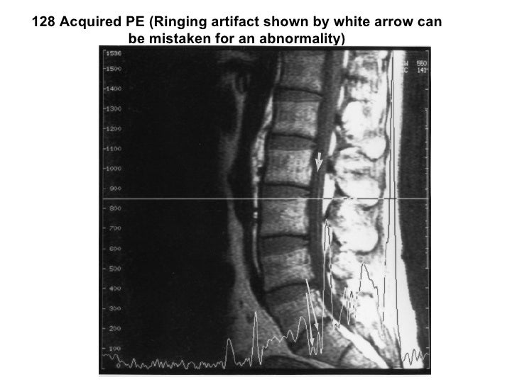 Mri Gibbs Ringing Artifact Reduction
