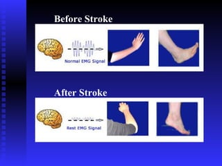 Presentation Biomove Stroke recovery system | PPT