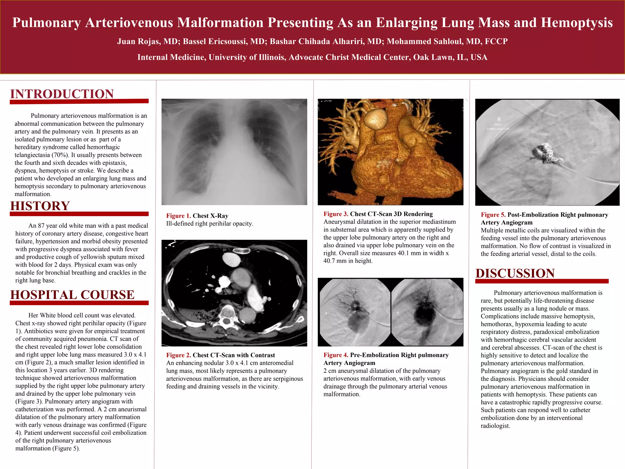 Pulmonary Arteriovenous Malformation Presenting As An Enlarging Lung ...