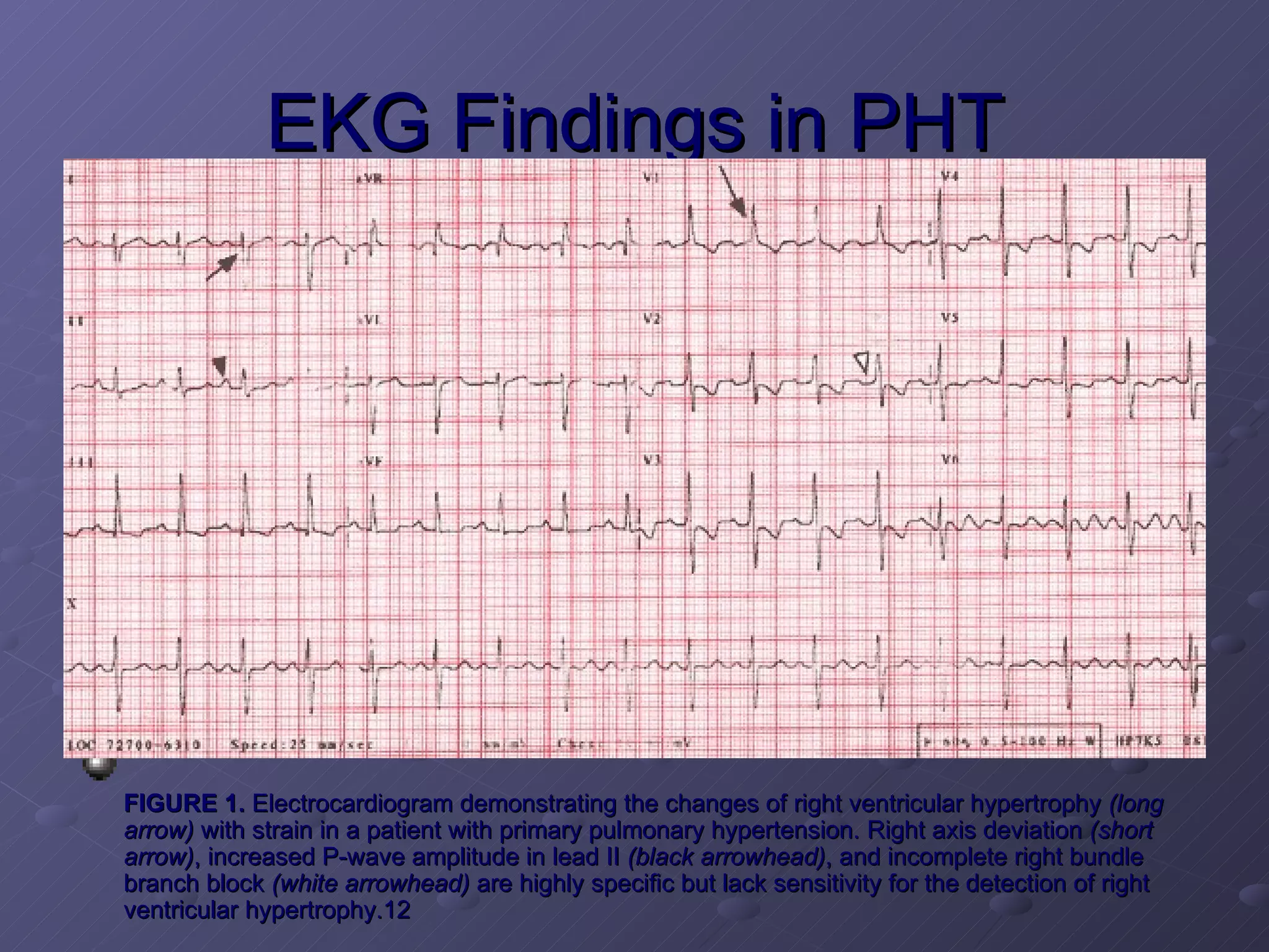 Pulmonary Hypertension 1 | PPT