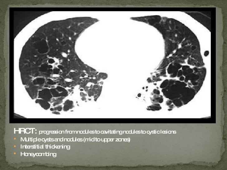 Pulmonary Langerhans Cell Histiocytosis (Plch), Eosinophilic Granulom…
