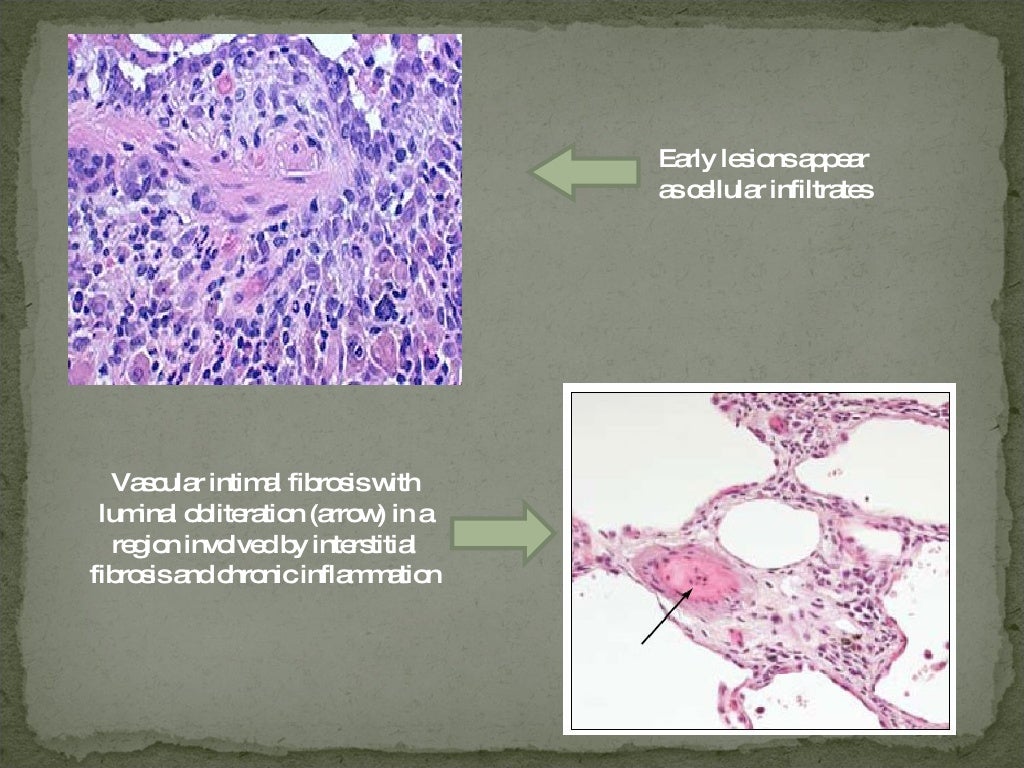 Pulmonary Langerhans Cell Histiocytosis (Plch), Eosinophilic Granulom…
