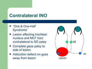 Superior Oblique Palsy | PPT