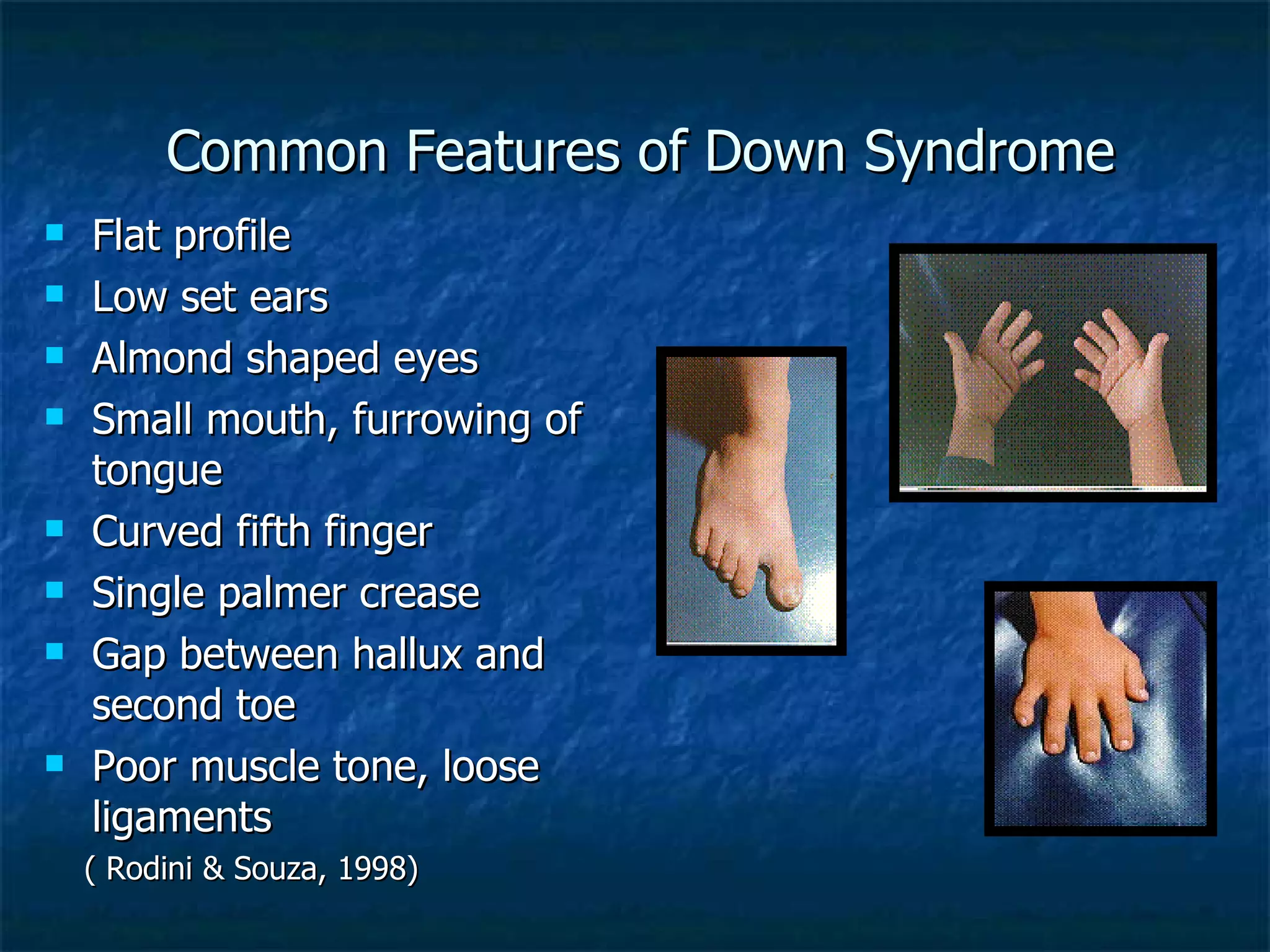 The Characteristics Of Down Syndrome | PPT