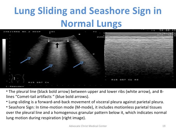 Thoracic Ultrasound For The Respiratory System In Critically Ill Pati…