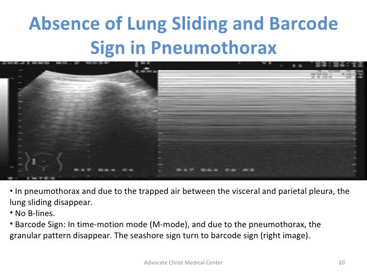 Thoracic Ultrasound For The Respiratory System In Critically Ill Pati…