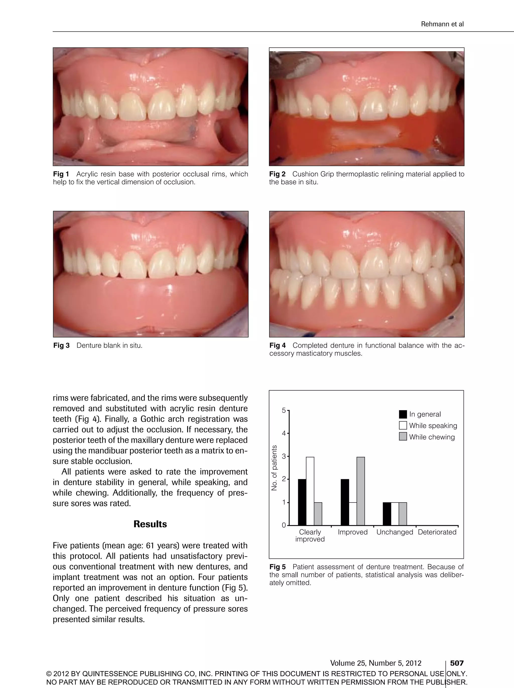 Alternative Procedure to Improve the Stability of Mandibular Complete ...