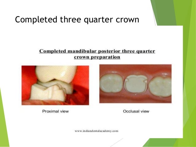 posterior partial veneer crown preparation