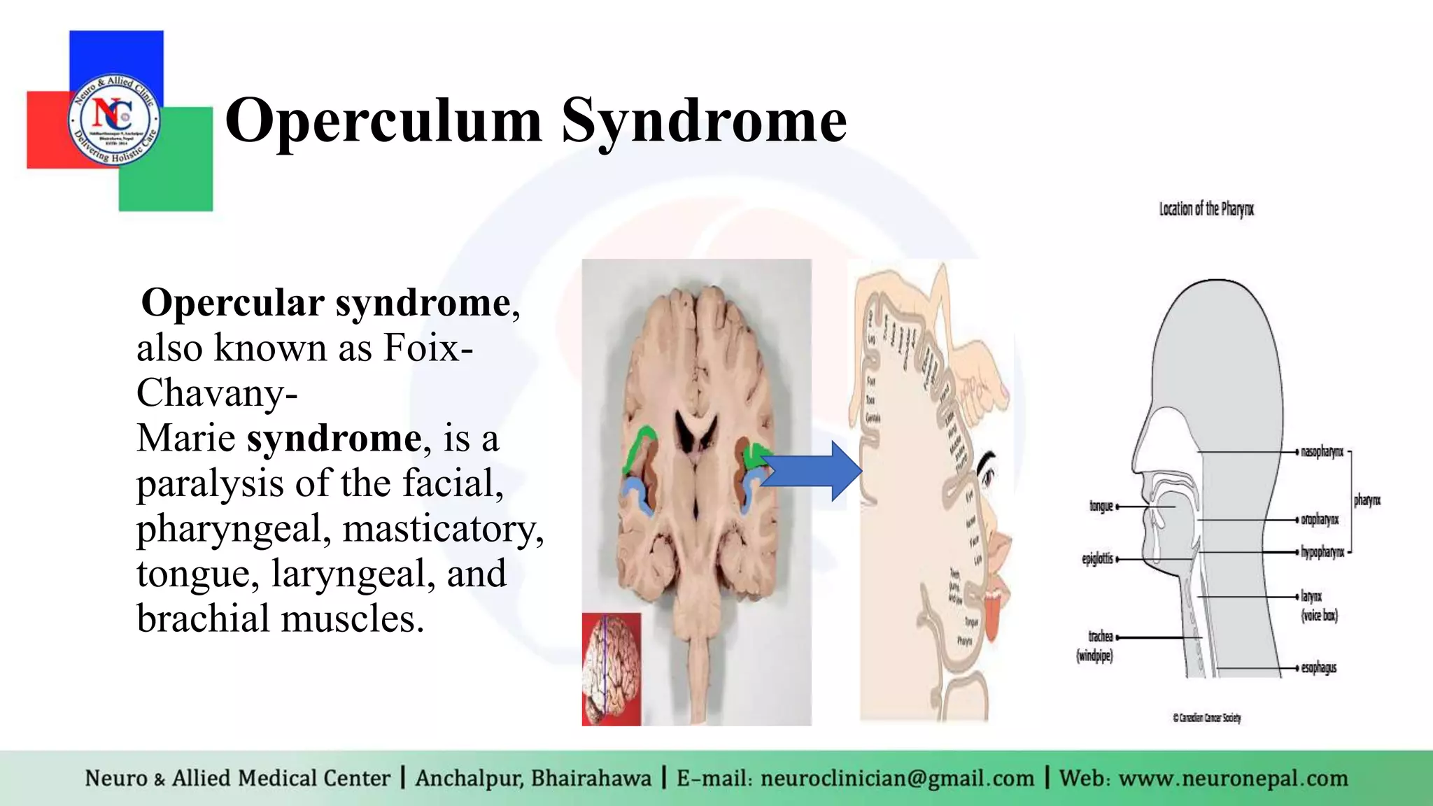 operculum syndrome | PPTX