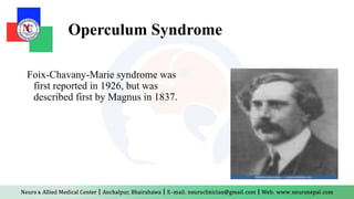 operculum syndrome | PPTX