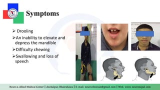operculum syndrome | PPTX