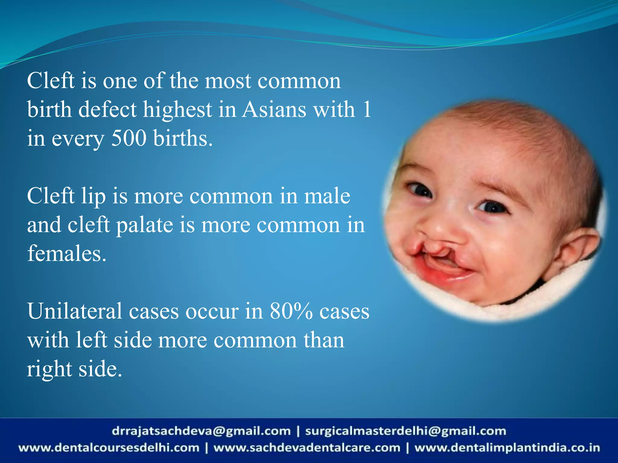 Cleft lip/Cleft Palate | Cleft Lip, Cleft Palate: What is a cleft lip ...