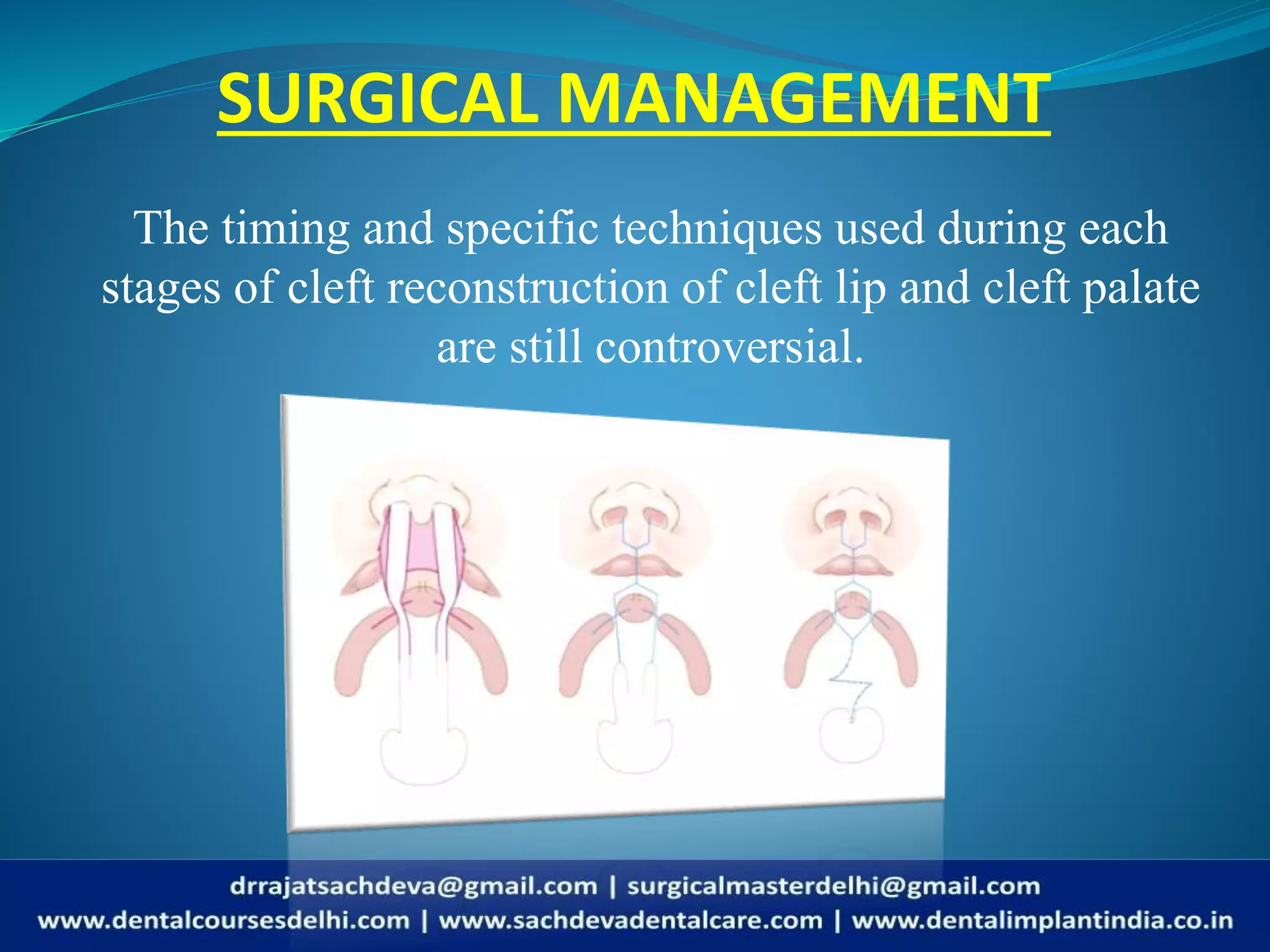 Cleft lip/Cleft Palate | Cleft Lip, Cleft Palate: What is a cleft lip ...