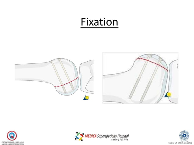 Hoffa Fracture(Bagaria Classification, Diagnosis and Management) PPT | PPTX