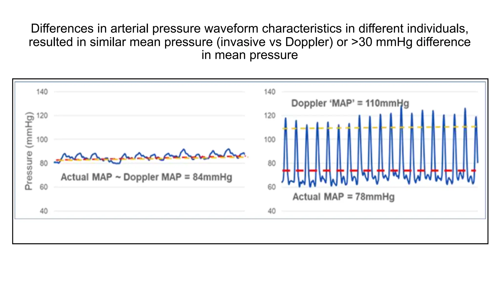 Non-Invasive assessment of arterial stiffness in advanced heart failure ...