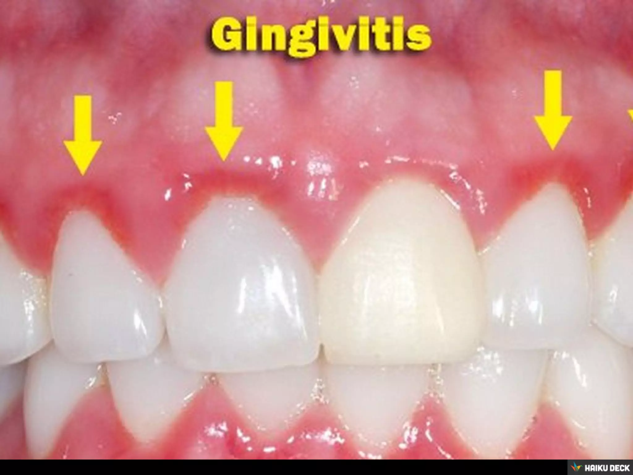 GINGIVITIS | PPT