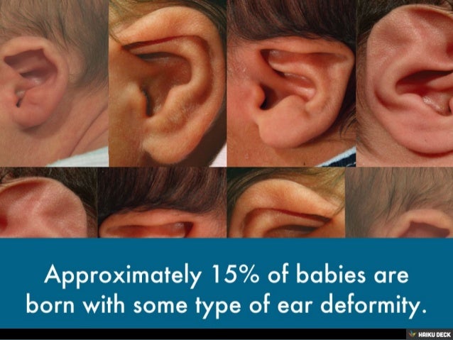 Ear Molding for Newborns