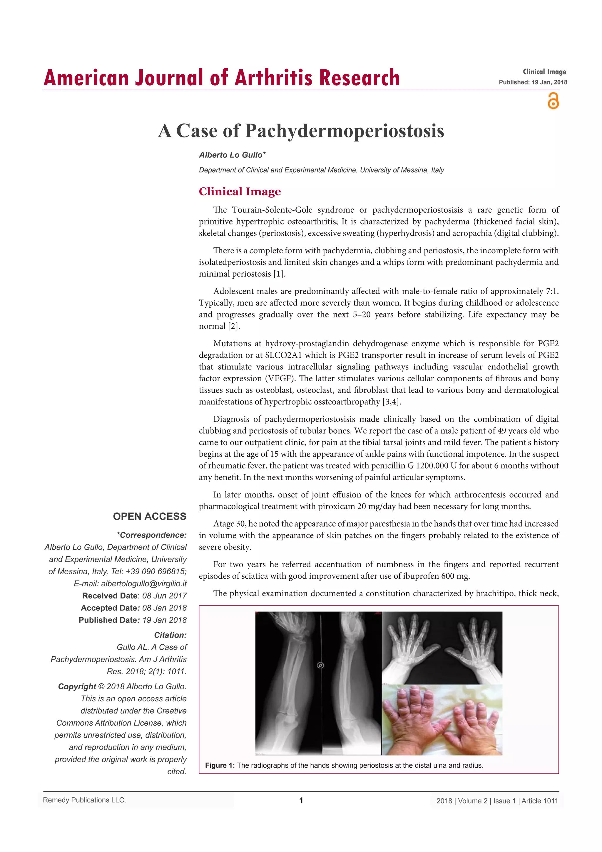 A Case of Pachydermoperiostosis | PDF