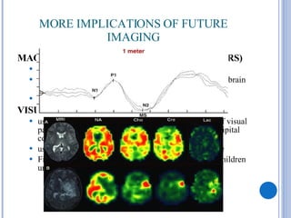 A Closer Look Into Optic Nerve Gliomas | PPT