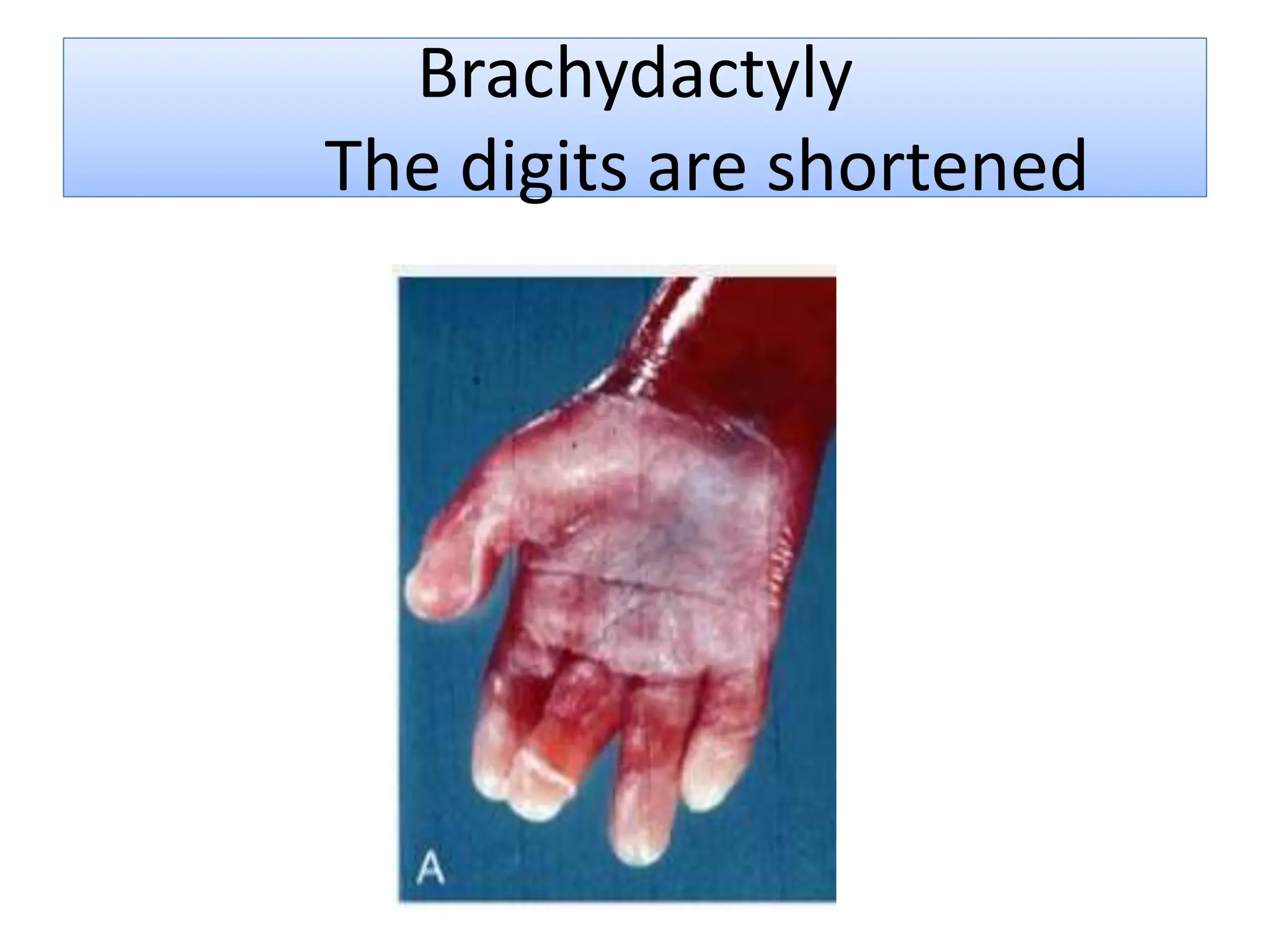 A-Development_of_Upper_Limb-16-12-14.ppt