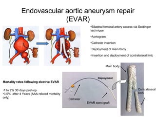 a rough guide to abdominal aortic aneurysms | PPT