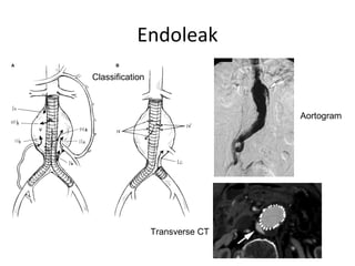 a rough guide to abdominal aortic aneurysms | PPT | Heart and Cardiovascular Diseases | Diseases ...