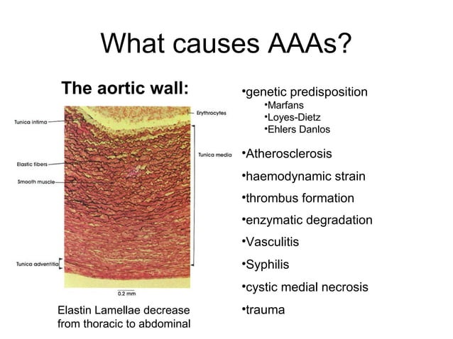 a rough guide to abdominal aortic aneurysms | PPT | Heart and Cardiovascular Diseases | Diseases ...