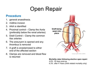 a rough guide to abdominal aortic aneurysms | PPT | Heart and ...