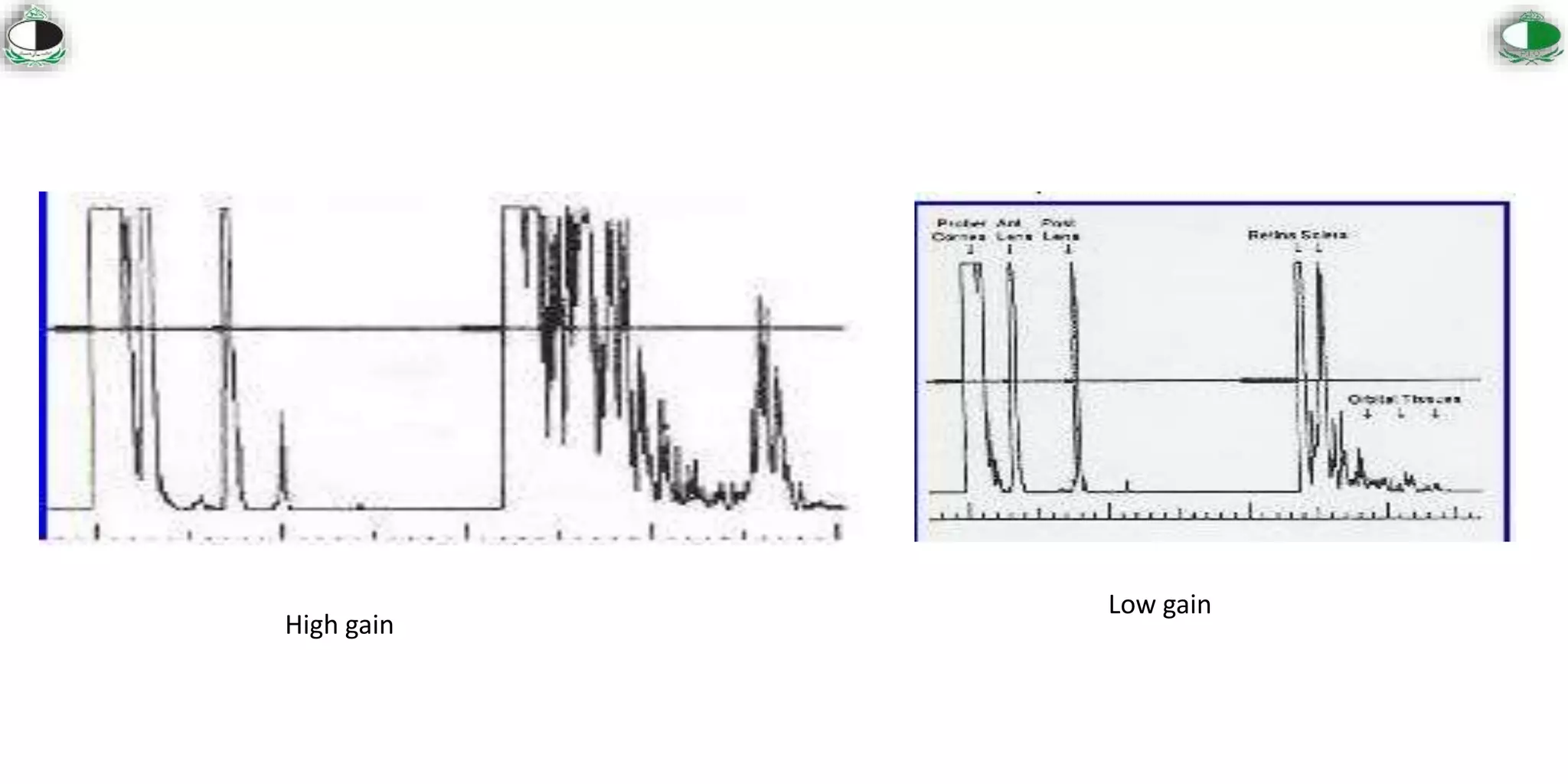 A-Scan Biometry.pptx