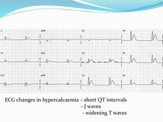 A Short Presentation on Hypercalcaemia | PPT