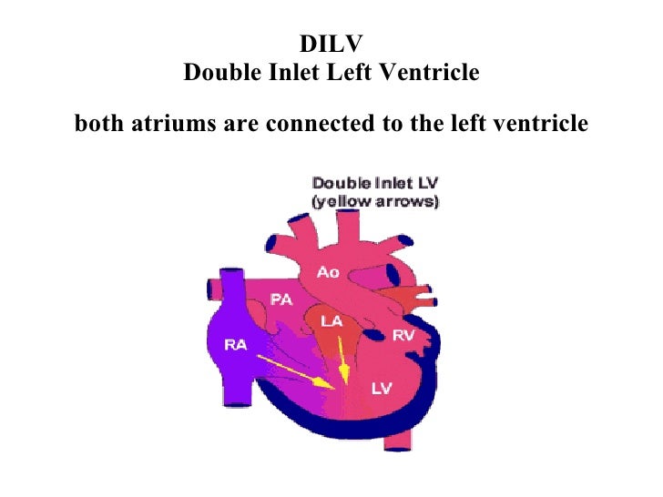 DILV Double Inlet Left Ventricle