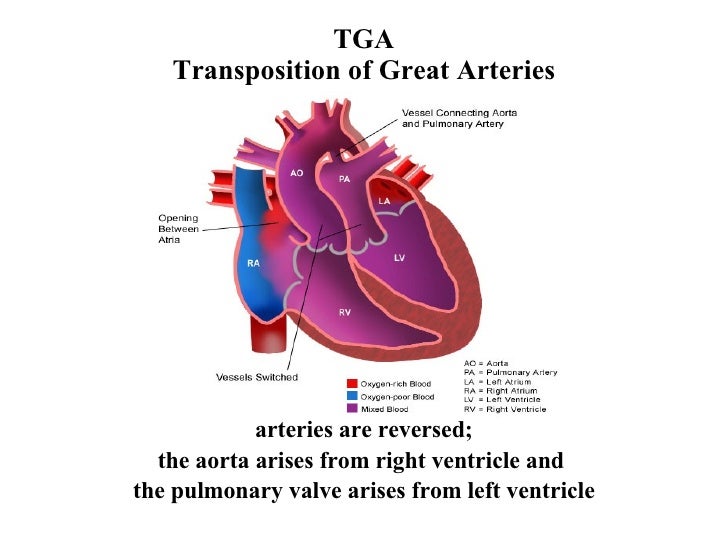 TGA Transposition of Great Arteries