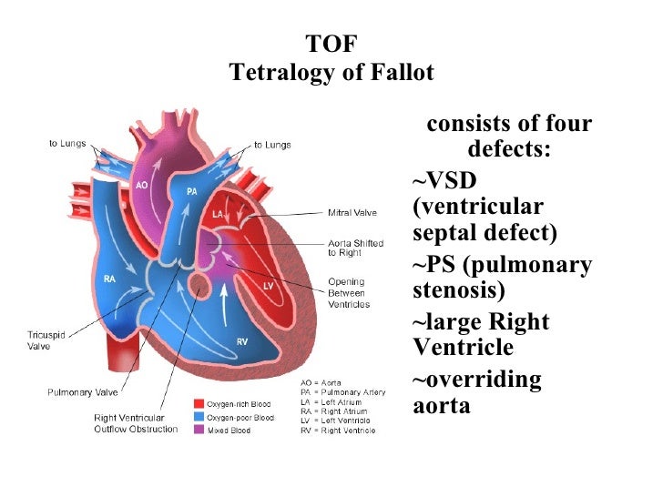 TOF Tetralogy of Fallot consists