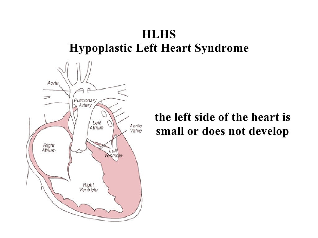 HLHS Hypoplastic Left Heart Syndrome