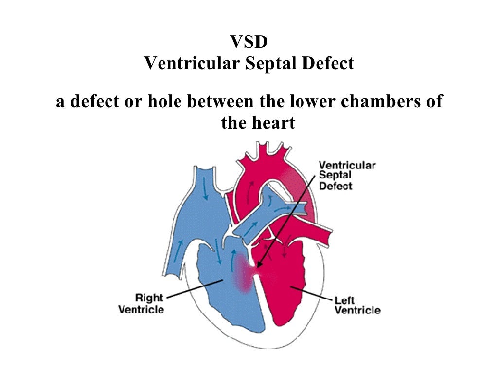 Ventricular Septal Defect
