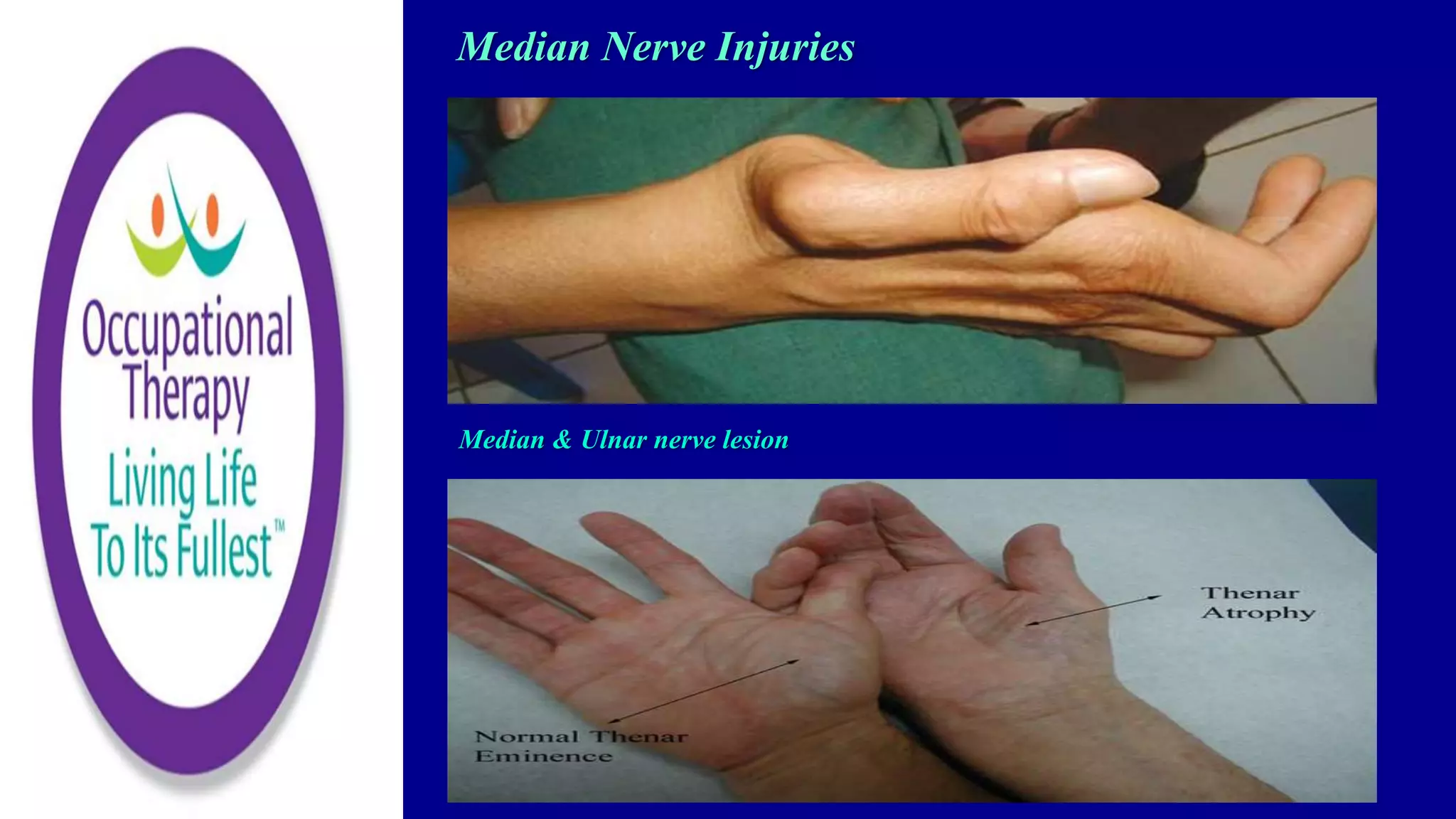 Occupational Therapy Upper Limb Injuries | PPTX
