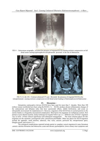 Case Report Migrated Iucd Causing Unilateral Obstrutive ...