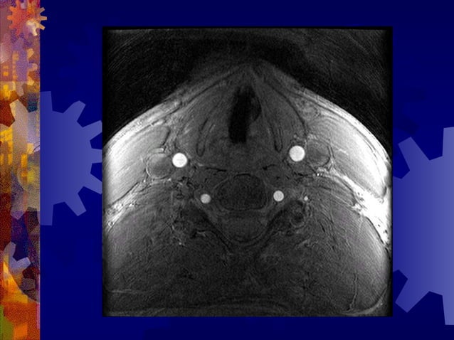 111 human carotid mri spio | PPT