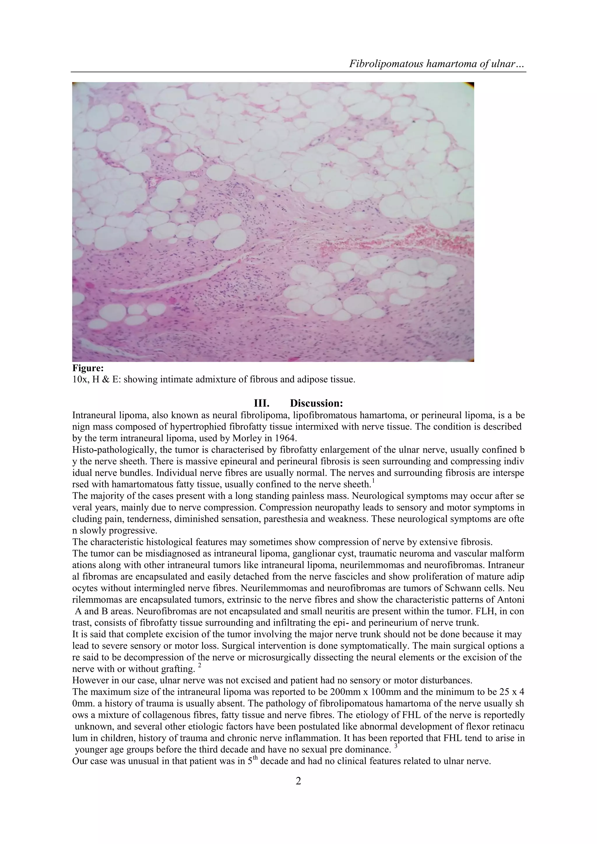 FIBROLIPOMATOUS HAMARTOMA OF ULNAR NERVE: A RARE CASE REPORT. | PDF