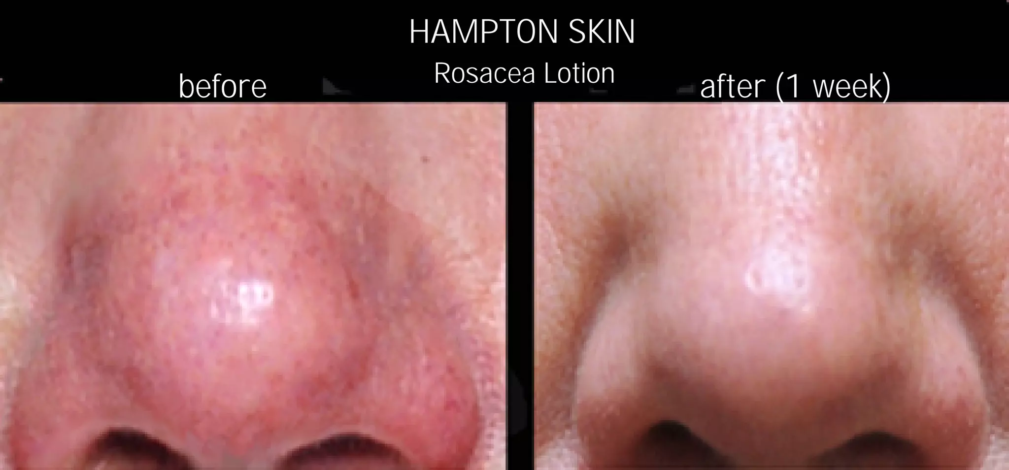 Rosacea of nose (rhinophyma) | PDF