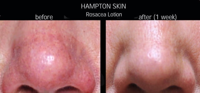 Rosacea of nose (rhinophyma) | PPT