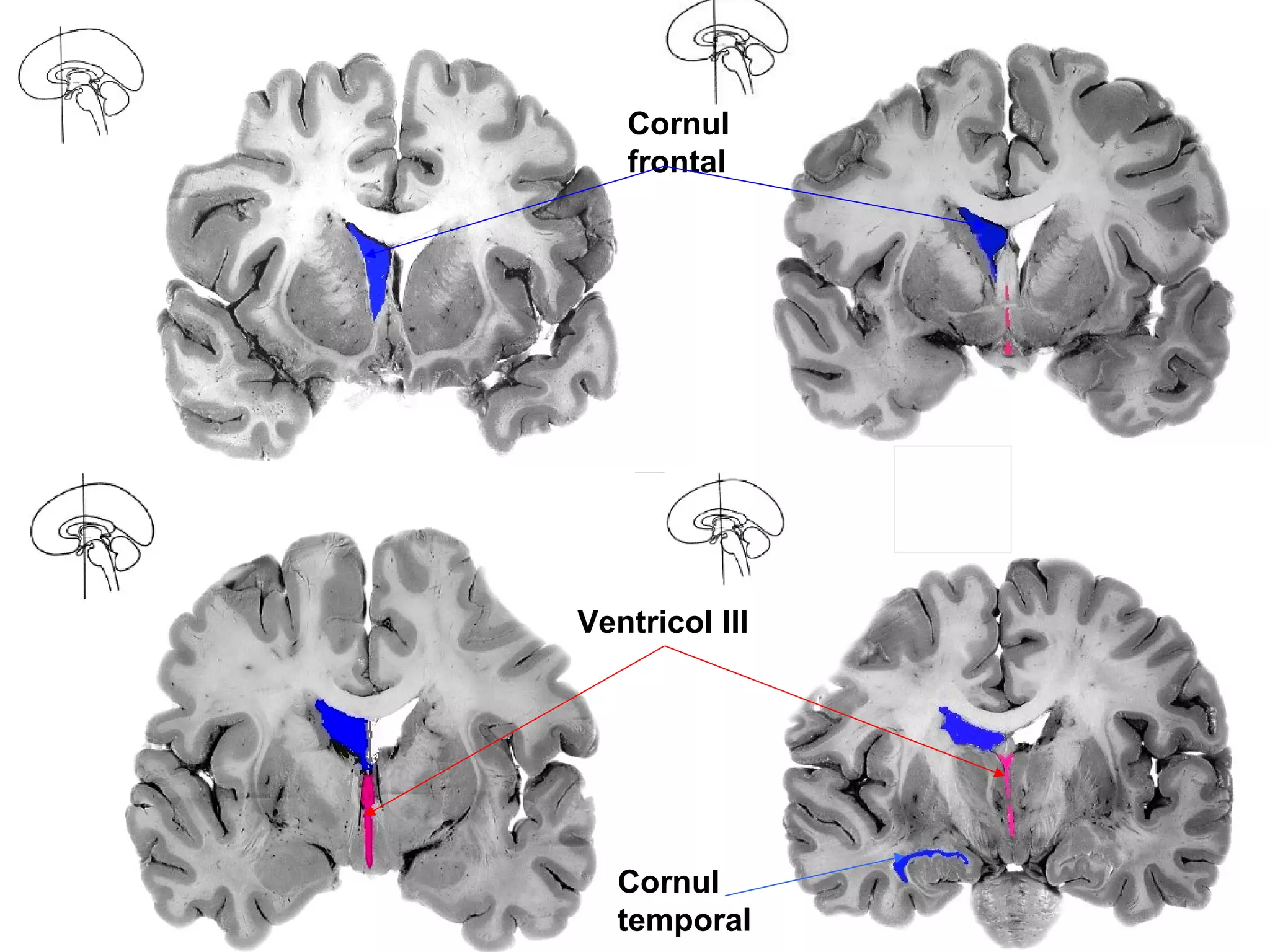 Atlas de neuroanatomie - Ventriculi cerebrali | PPT