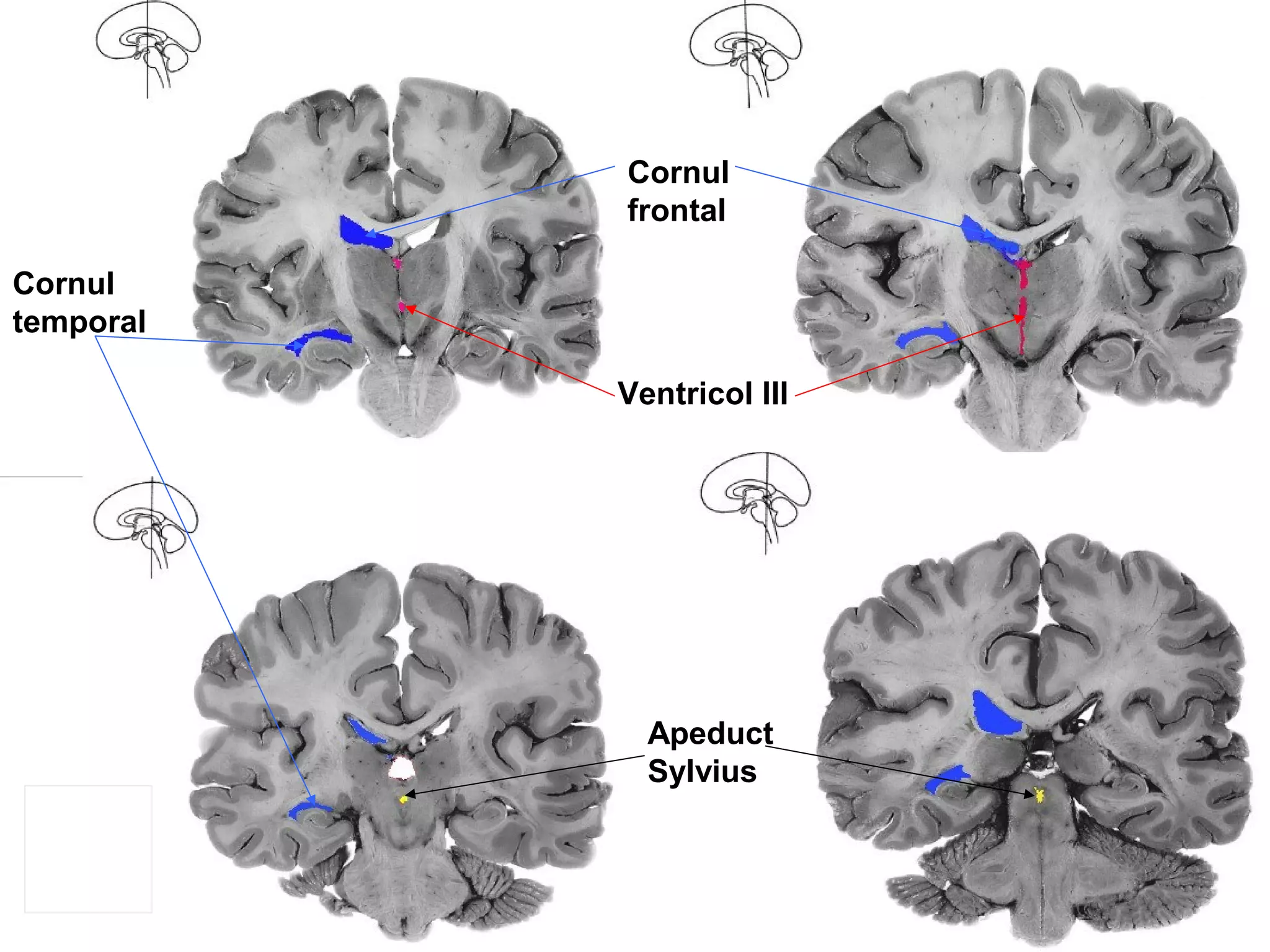 Atlas de neuroanatomie - Ventriculi cerebrali | PPT