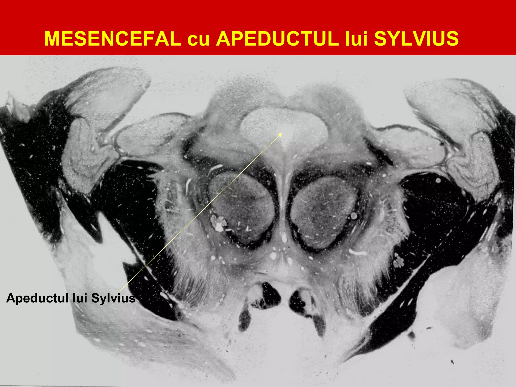 Atlas de neuroanatomie - Ventriculi cerebrali | PPT