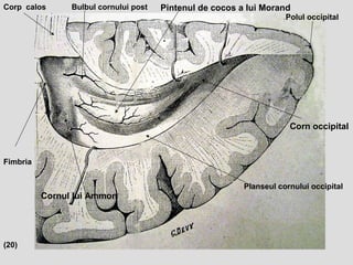 Atlas de neuroanatomie - Ventriculi cerebrali | PPT